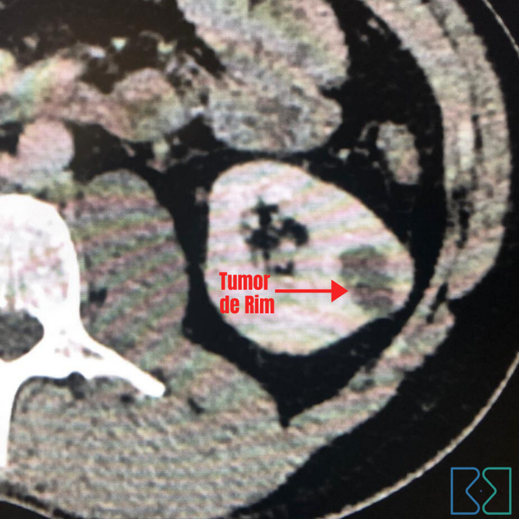 Ablação de rim: O que é e quando está indicado?
