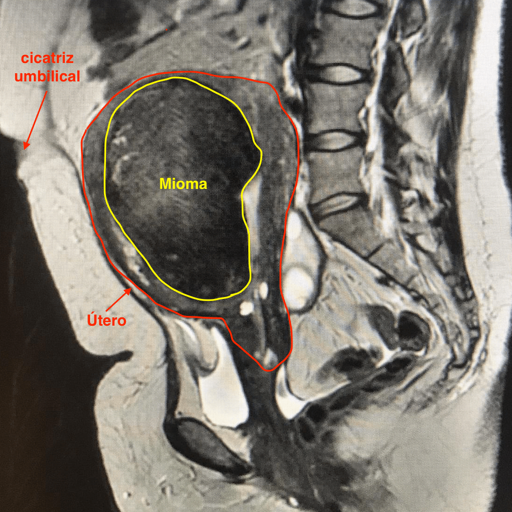 Embolização de Miomas Uterinos