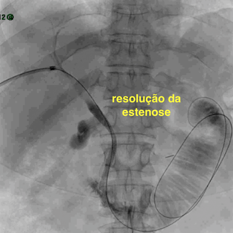Implante de Stent Biliar | Prótese Biliar - Dica Médica