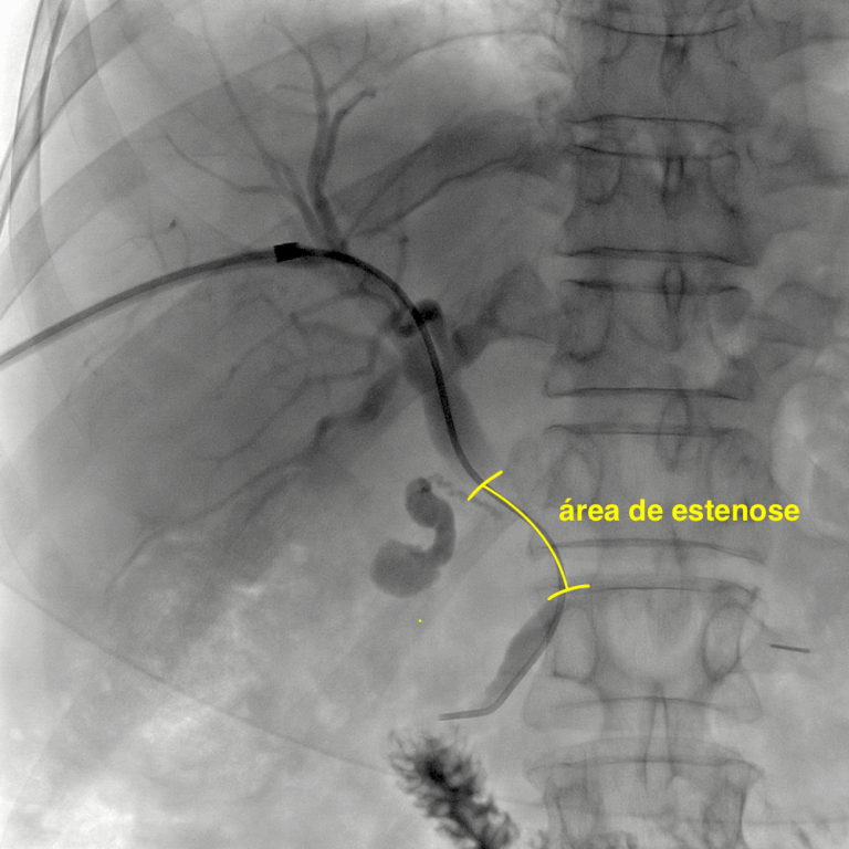 Implante de Stent Biliar | Prótese Biliar - Dica Médica