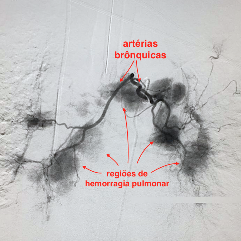 Medicina e Radiologia Intervencionista | Embolização de hemoptise