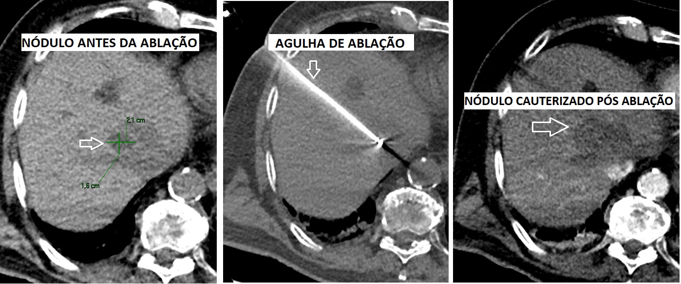 Ablação e embolização: conheça as técnicas e suas diferenças