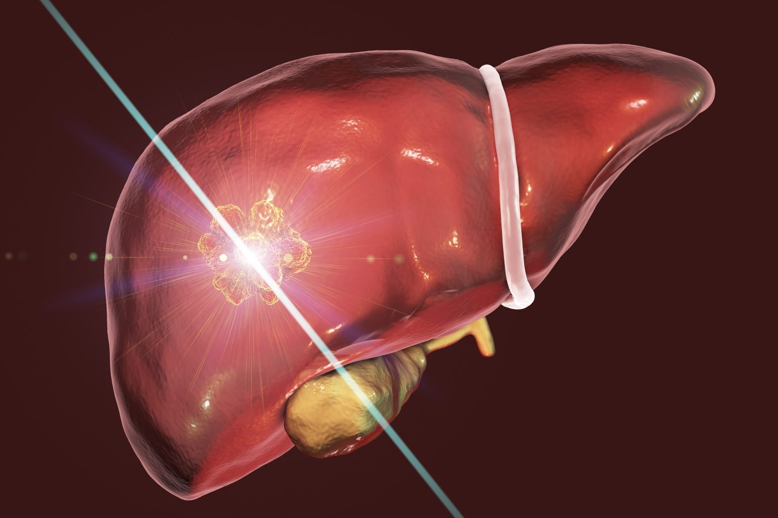 O que é o carcinoma hepatocelular? Conheça os seus sintomas e fatores ...