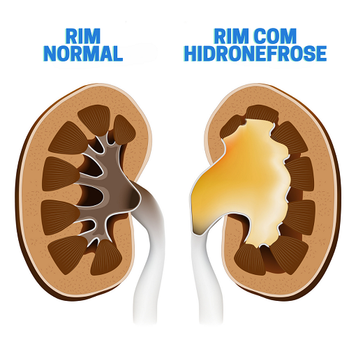 Hidronefrose: quando a urina se acumula no rim