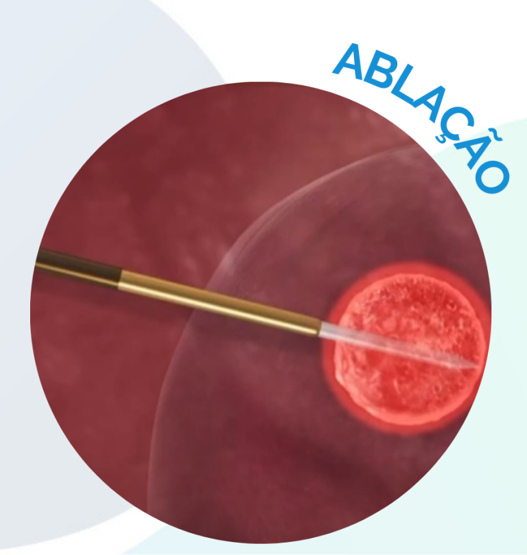 Ablação Um Guia Completo Dica Médica