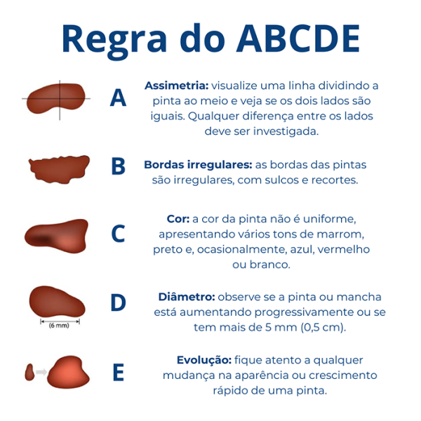 Conheça a Regra do ABCDE que pode ajudar na prevenção do câncer de pele ...